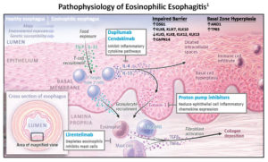 Current and Future Treatments of EoE – EoE Restore | Clinician